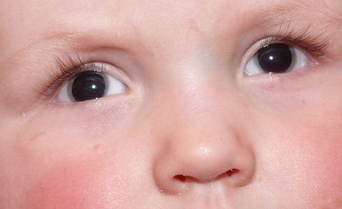 Aniridie | Čočky-kontaktní.cz