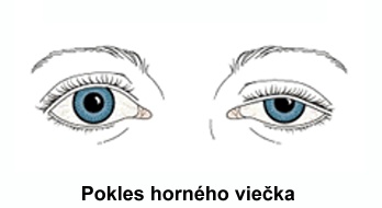 Slovník: Ptóza